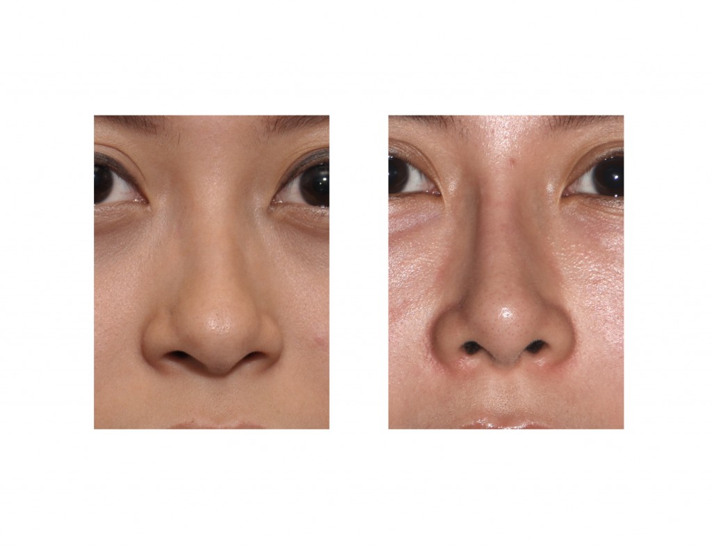 Plastic Surgery Case Study - Female Nasal Implant Augmentation ...