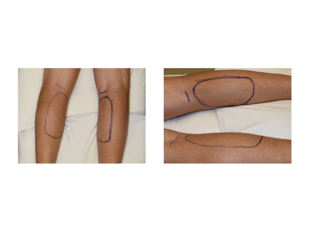 Surgical Techniques in Calf Implants - Explore Plastic Surgery