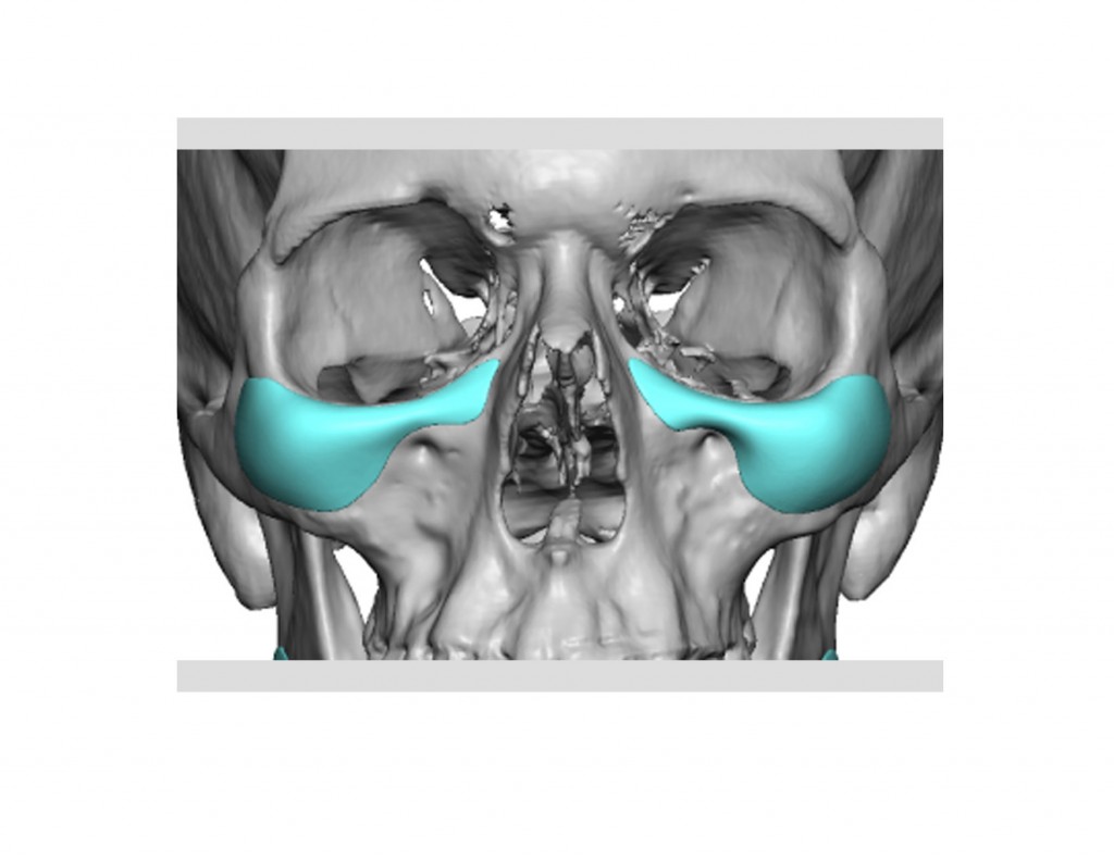 Lower Eyelid Incisional Placement of Custom Infraorbital Malar Implants ...
