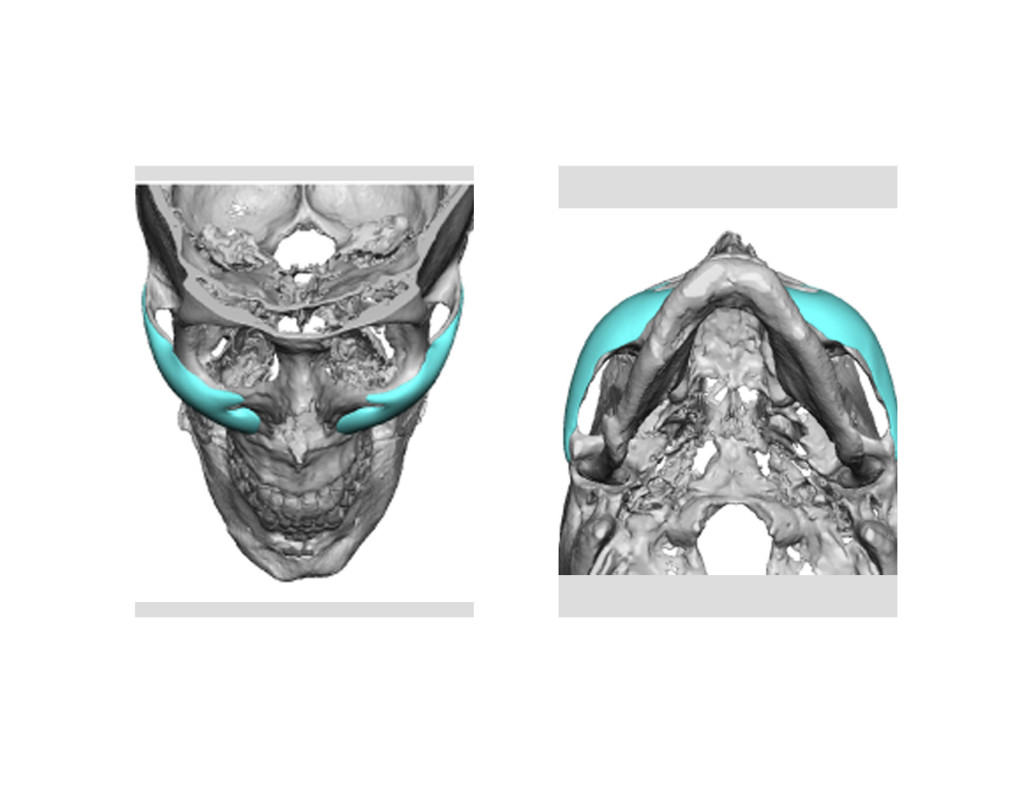 Concepts for Custom Male Cheek Implants - Explore Plastic Surgery