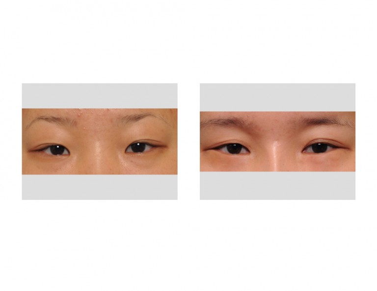Plastic Surgery Case Study - Double Eyelid Surgery for Indistinct ...