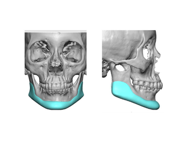 Swelling and Recovery after Custom Jawline Implant Surgery - Explore ...