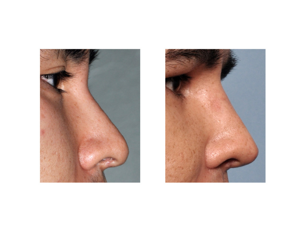Plastic Surgery Case Study - Custom Nasal Implant for Larger Dorsal ...