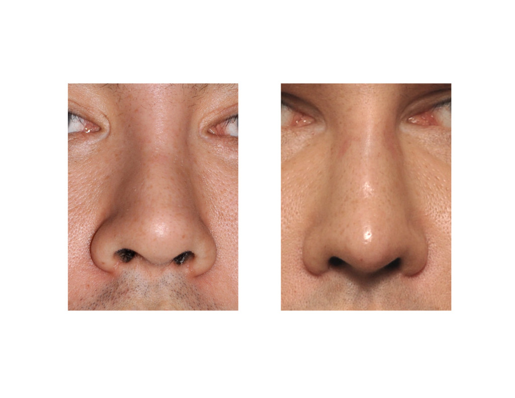 Plastic Surgery Case Study - Custom Nasal Implant for Larger Dorsal ...