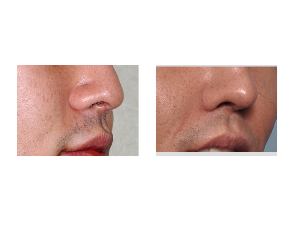 Plastic Surgery Case Study - Custom Paranasal Implant for Base of Nose ...