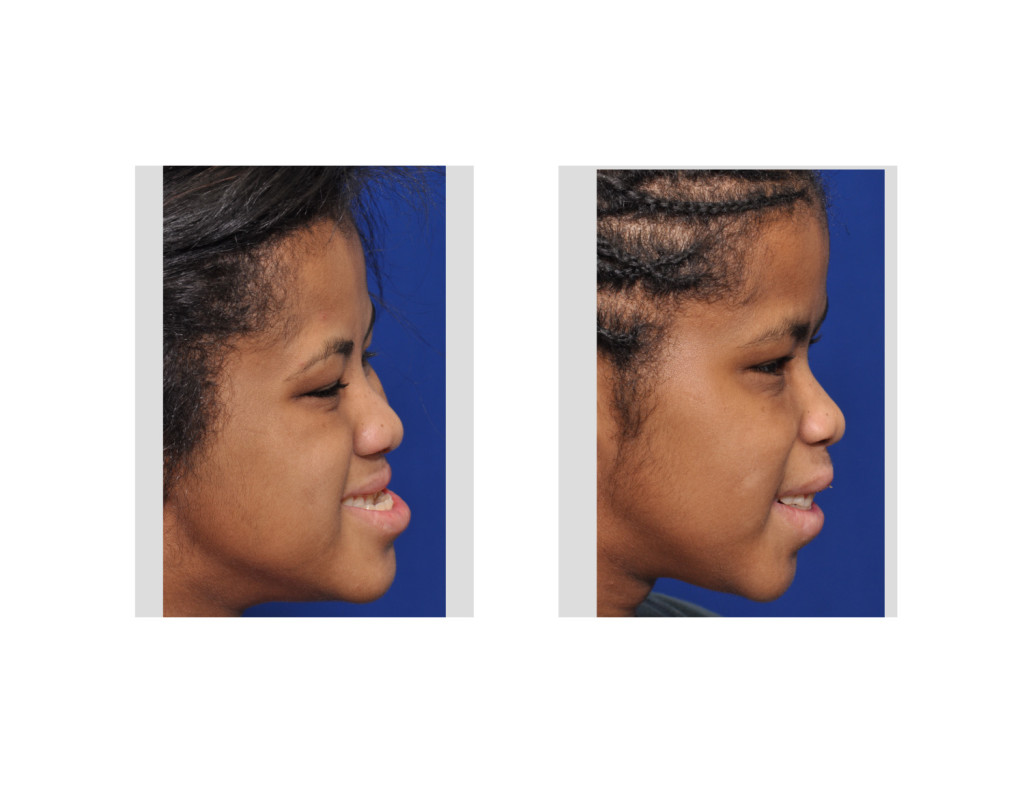 Plastic Surgery Case Study - Non-Orthodontic LeFort 1 Advancement ...
