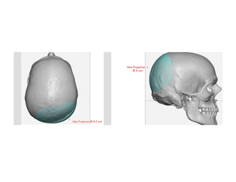 Plastic Surgery Case Study - Custom Occipital Skull Implant for ...