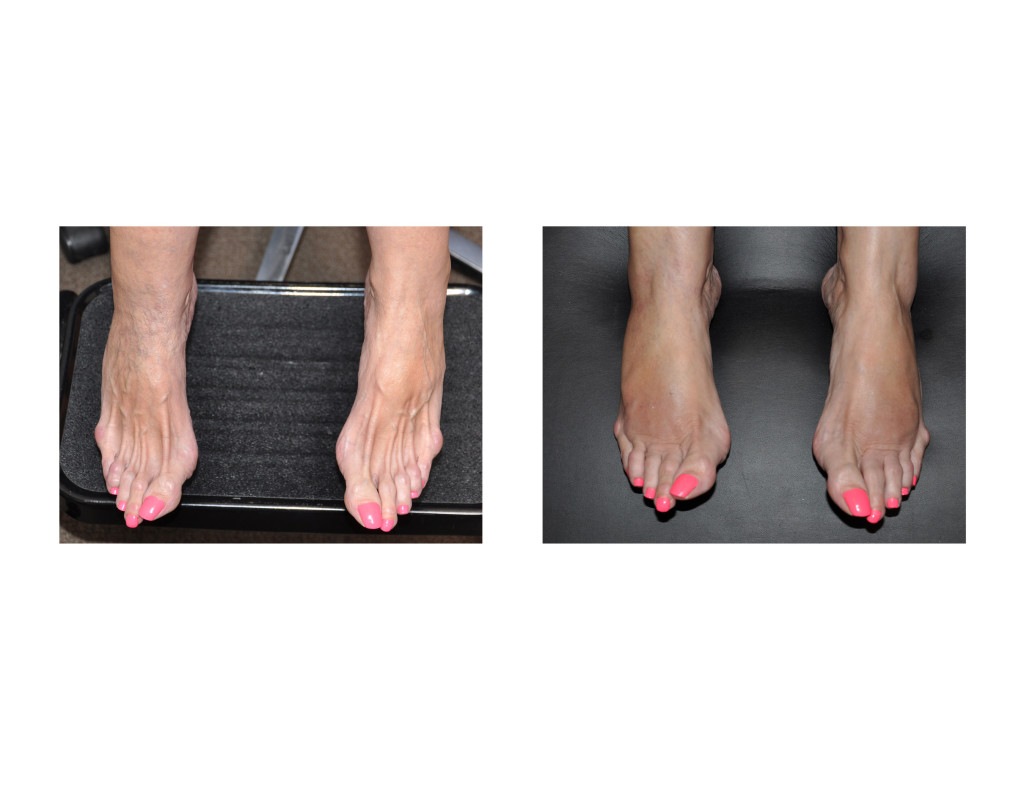 Foot Fat Grafting for Chronic Pain - Explore Plastic Surgery