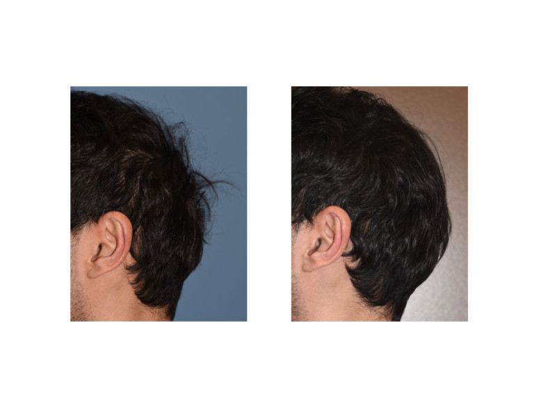 Plastic Surgery Case Study - Custom Occipital Skull Implant for Upper ...
