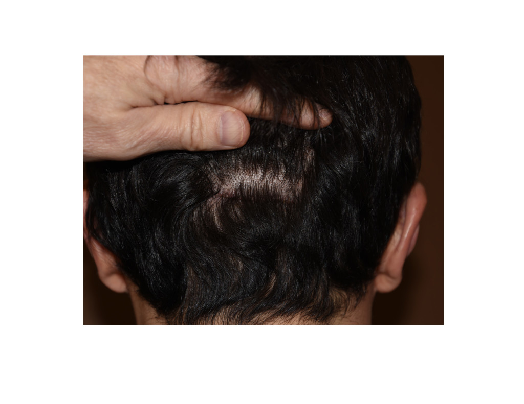 Plastic Surgery Case Study - Custom Occipital Skull Implant for Upper ...