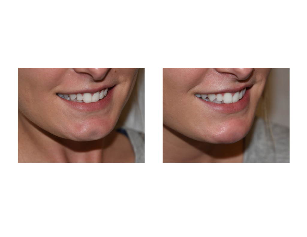 Chin Dimple Injection Test before Fat Injections or Injectable Fillers ...