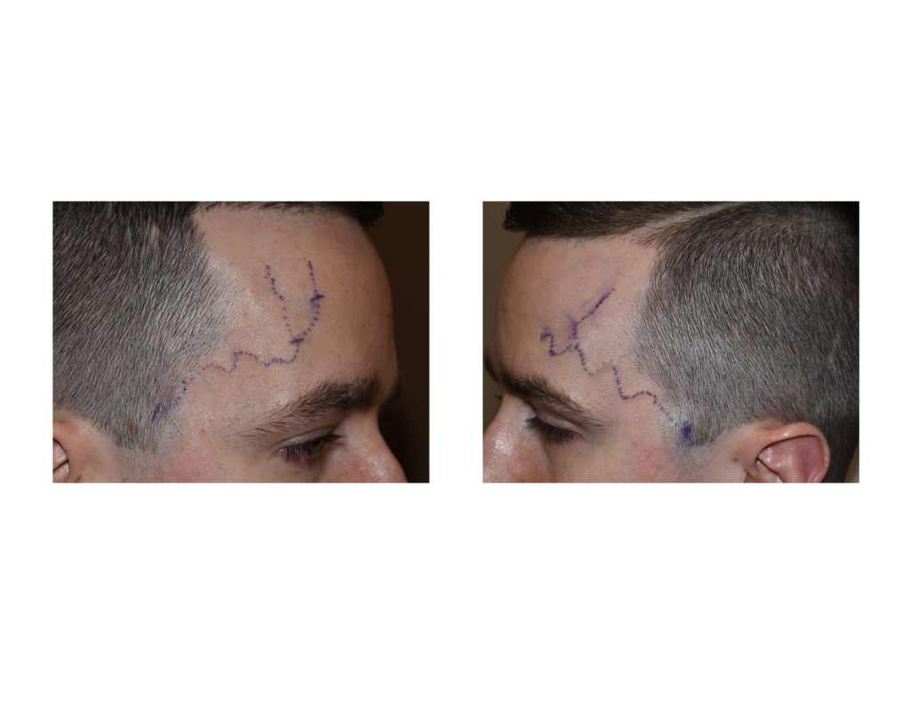 Single Point Temporal Artery Ligation For Prominent Forehead Vessel ...