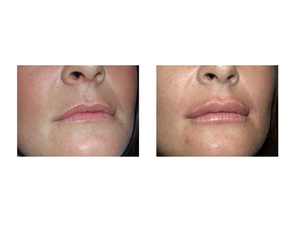 Lip Injections using Buccal Fat - Explore Plastic Surgery