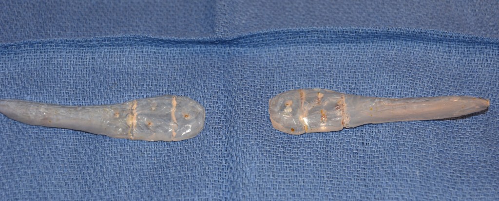 Hand Carved Extended Cheek Implants for High Cheekbone Look - Explore ...