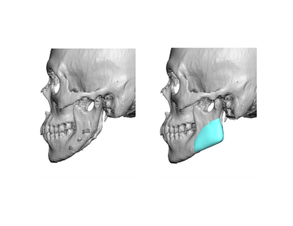Plastic Surgery Case Study - Custom Jaw Angle Implants for ...