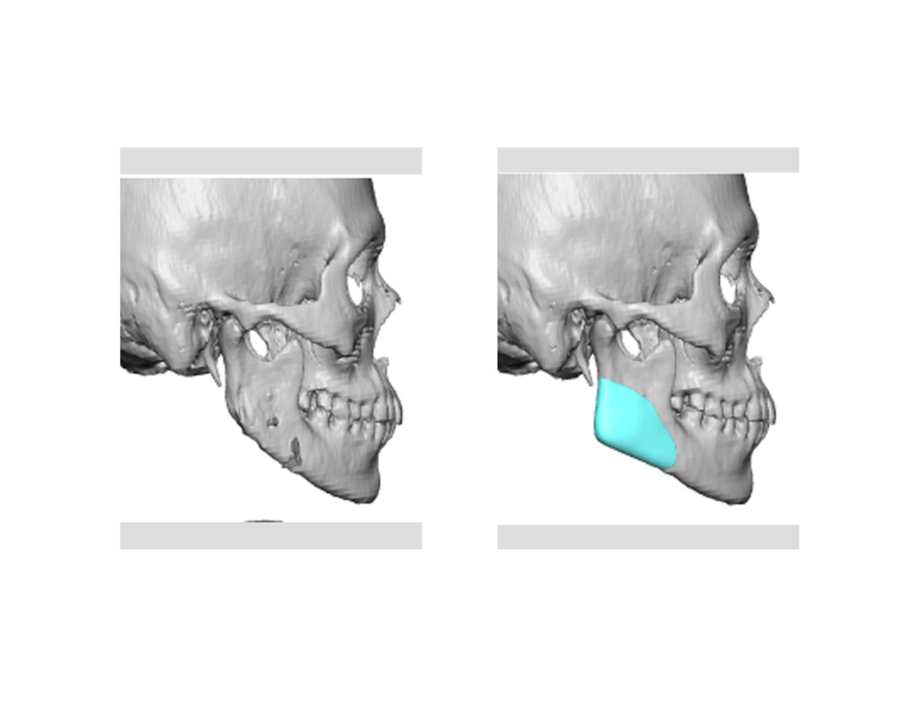 Plastic Surgery Case Study - Custom Jaw Angle Implants for ...
