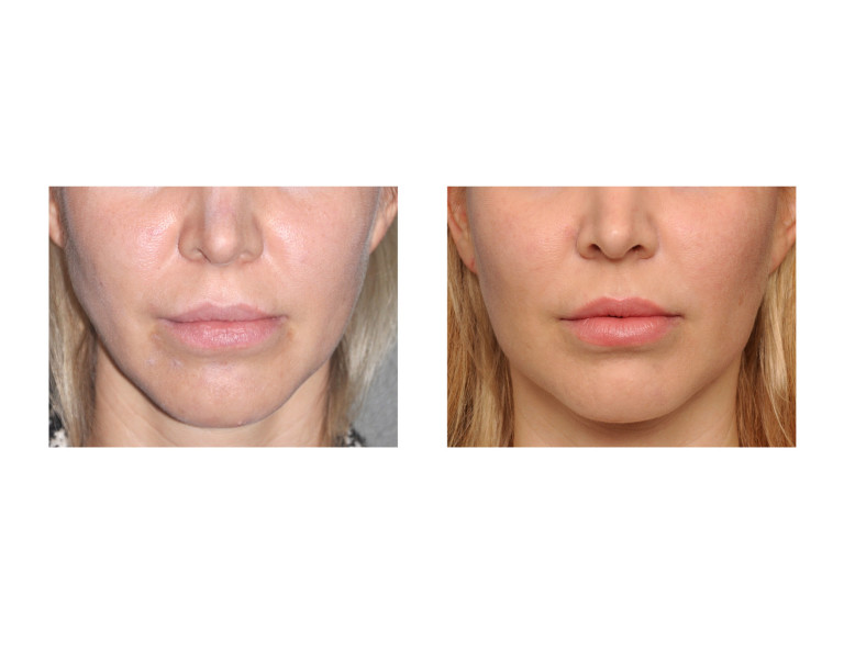 Plastic Surgery Case Study - Female Jaw Angle Implants - Explore ...