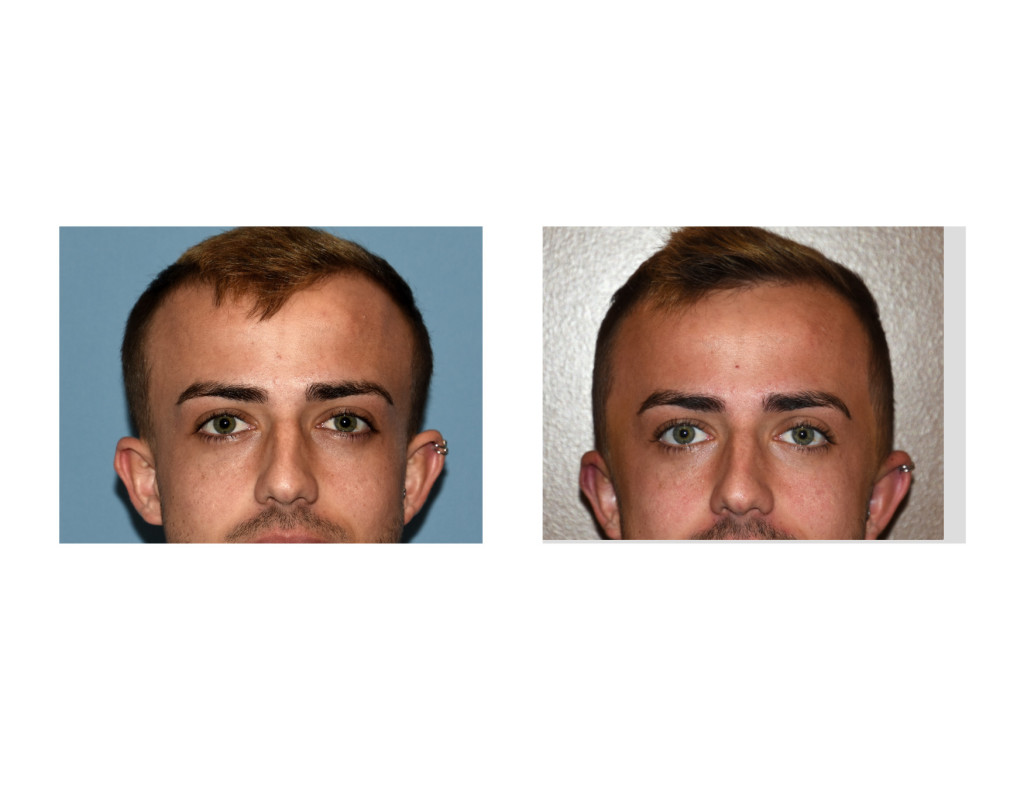Plastic Surgery Case Study - Head Width Narrowing By Temporal Reduction ...