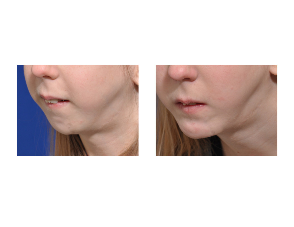 Plastic Surgery Case Study - Jumping Genioplasty for Severe Chin/Jaw ...