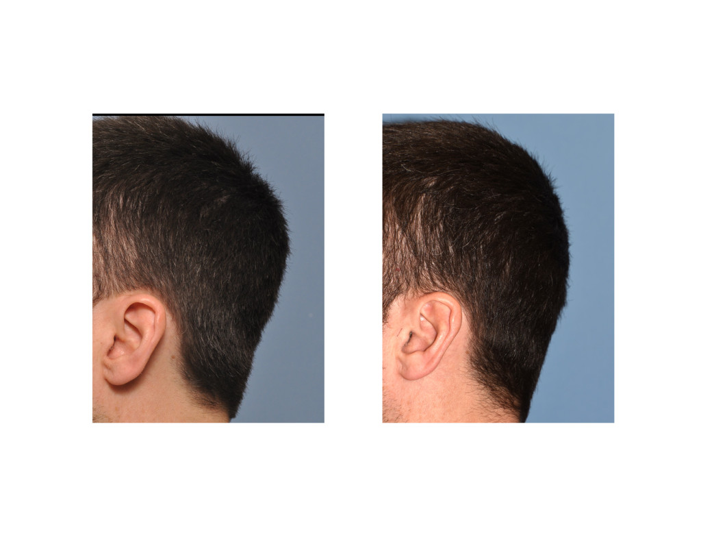 Plastic Surgery Case Study - Occipital Skull Reduction - Explore ...