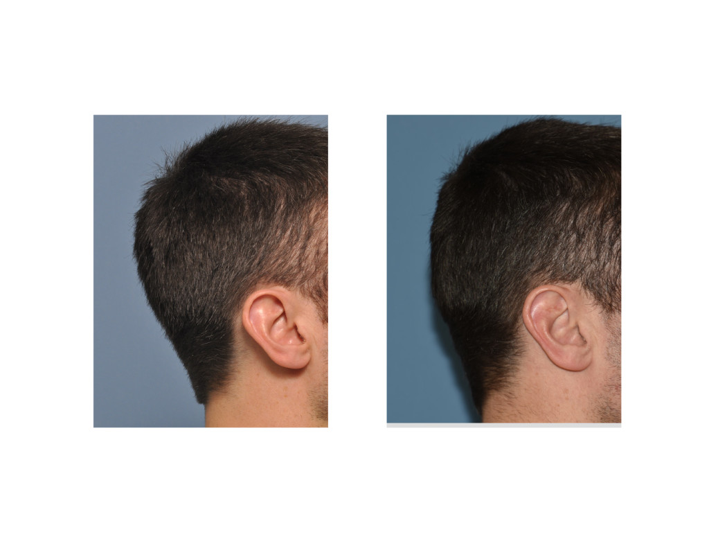 Plastic Surgery Case Study - Occipital Skull Reduction - Explore ...
