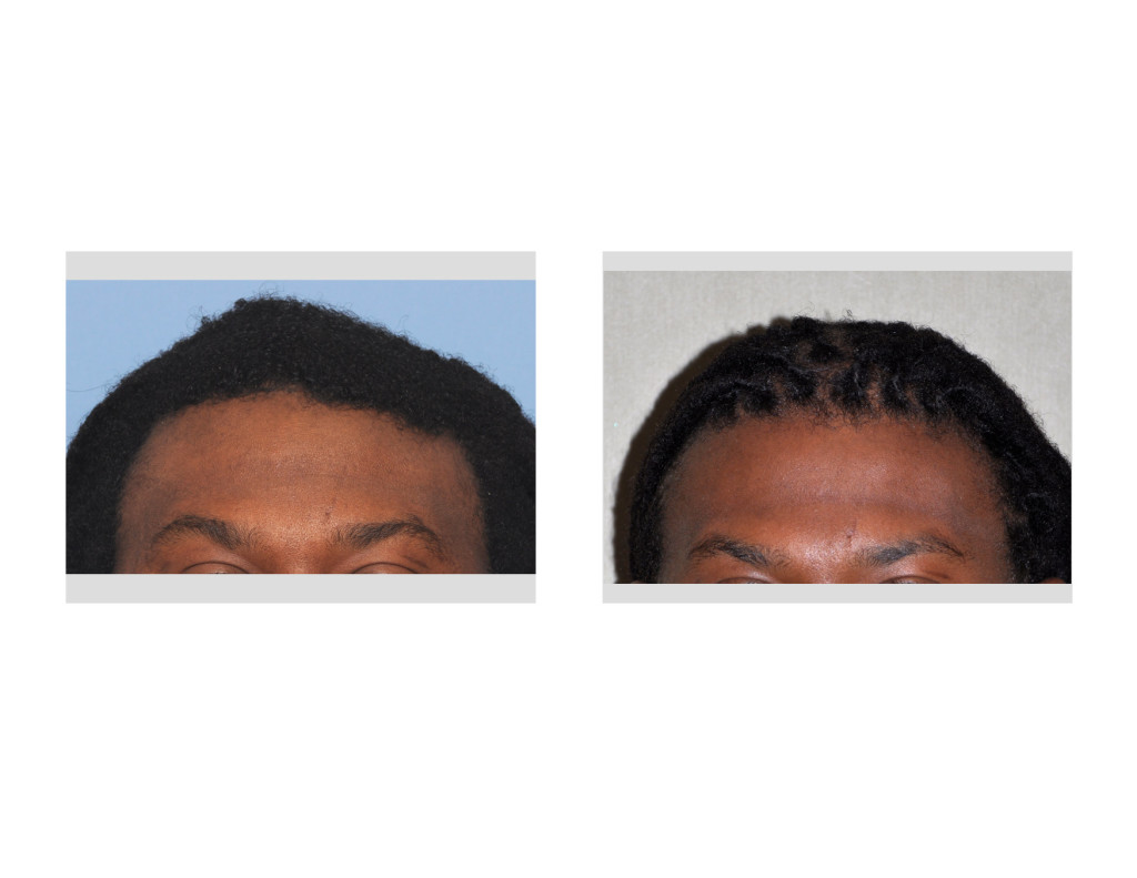 Plastic Surgery Case Study - Sagittal Ridge Skull Reduction with ...
