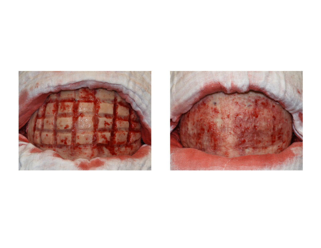 Technical Strategies - Large Skull Reduction and the Grid Approach ...