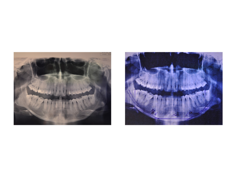 Preoperative X-Ray Planning in Submental Chin Reduction - Explore ...