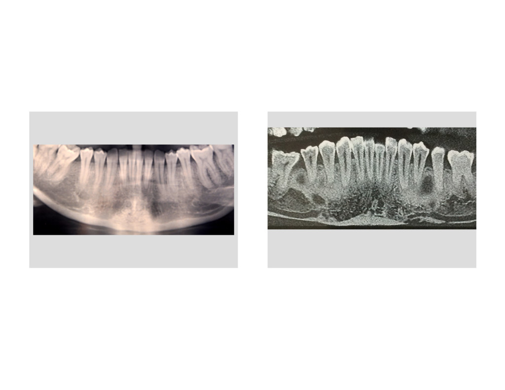 Preoperative X-Ray Planning in Submental Chin Reduction - Explore ...