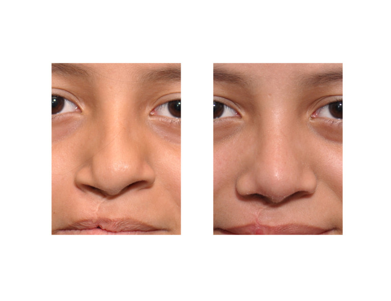 Plastic Surgery Case Study - Rib Graft Cleft Rhinoplasty - Explore ...