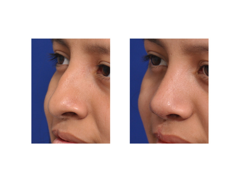 Plastic Surgery Case Study - Rib Graft Cleft Rhinoplasty - Explore ...