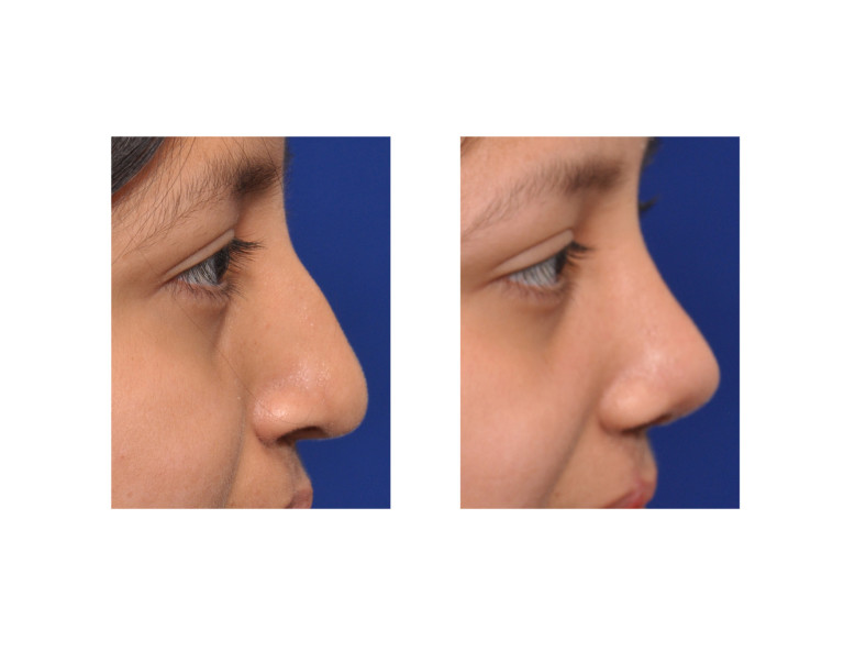 Plastic Surgery Case Study - Rib Graft Cleft Rhinoplasty - Explore ...