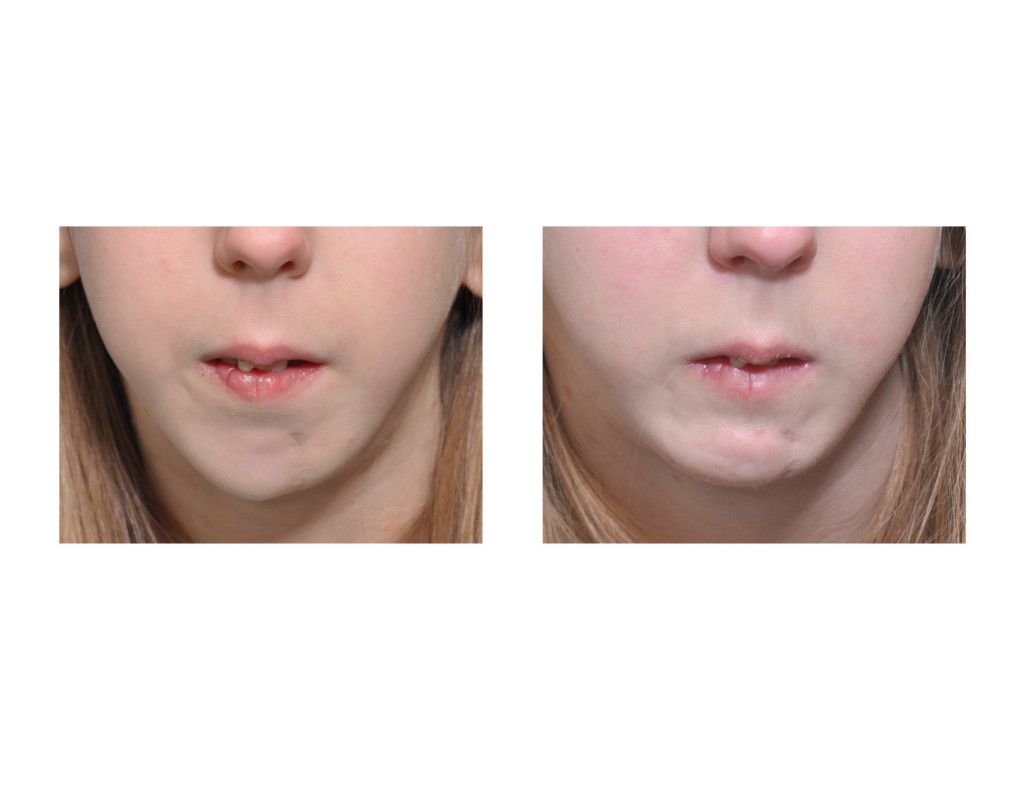 Plastic Surgery Case Study - Jumping Genioplasty for Severe Chin/Jaw ...