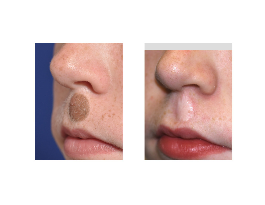 Upper Lip Nevis Excision with Skin Grafting result oblioque view Dr ...