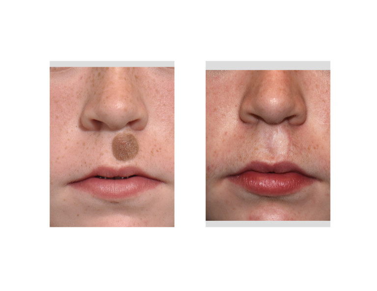 Plastic Surgery Case Study - Excision and Skin Grafting of Large ...