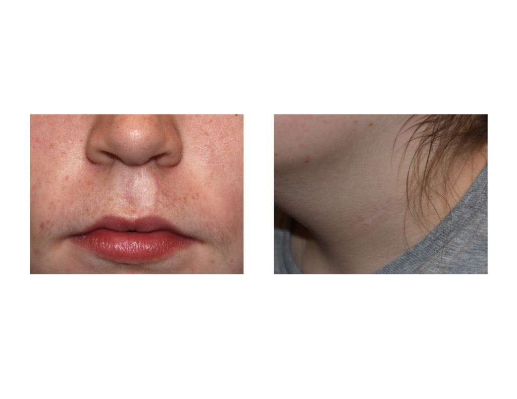 Plastic Surgery Case Study - Excision and Skin Grafting of Large ...