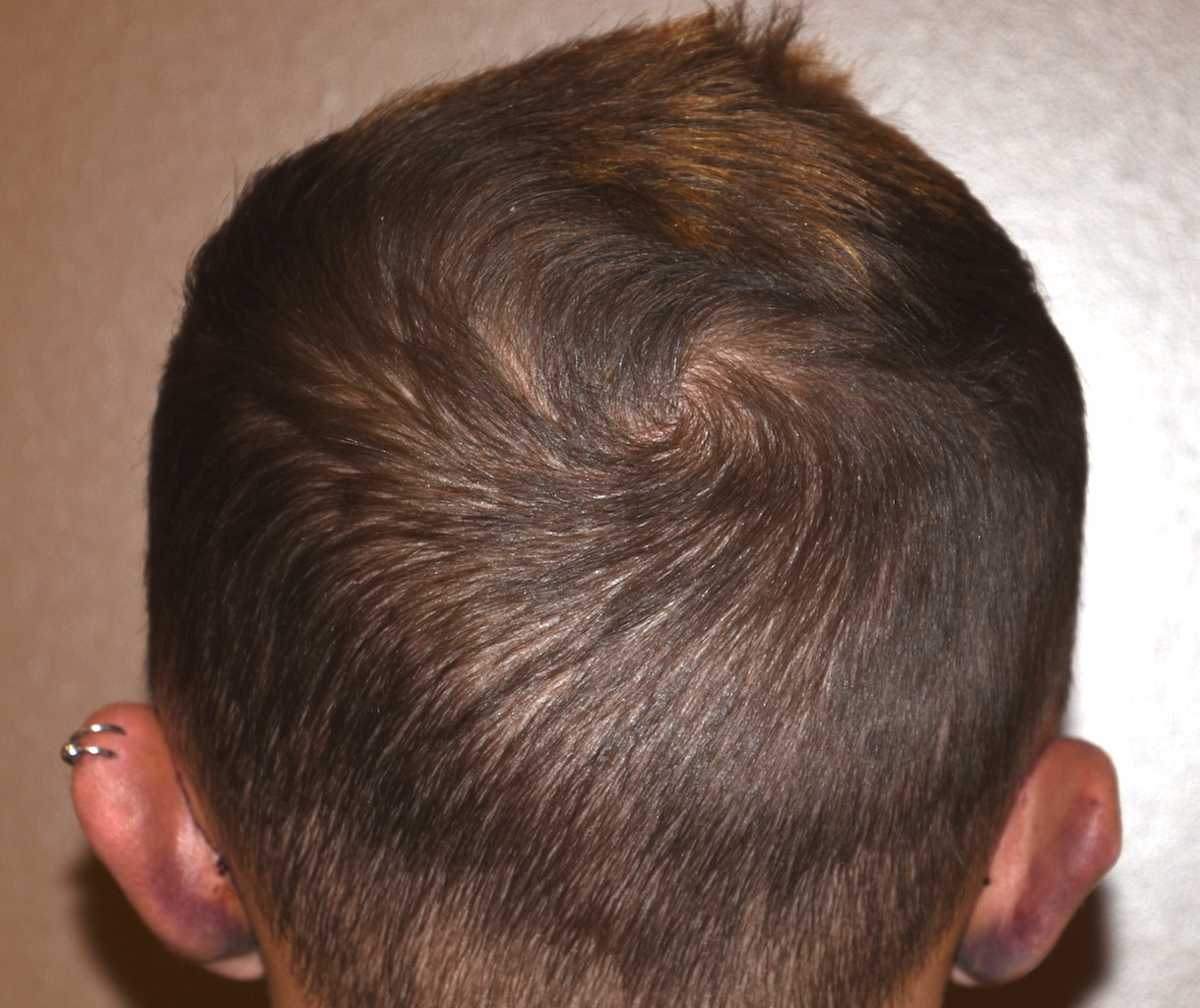 young male temporal reduction back 2 Dr Barry Eppley - Explore Plastic ...