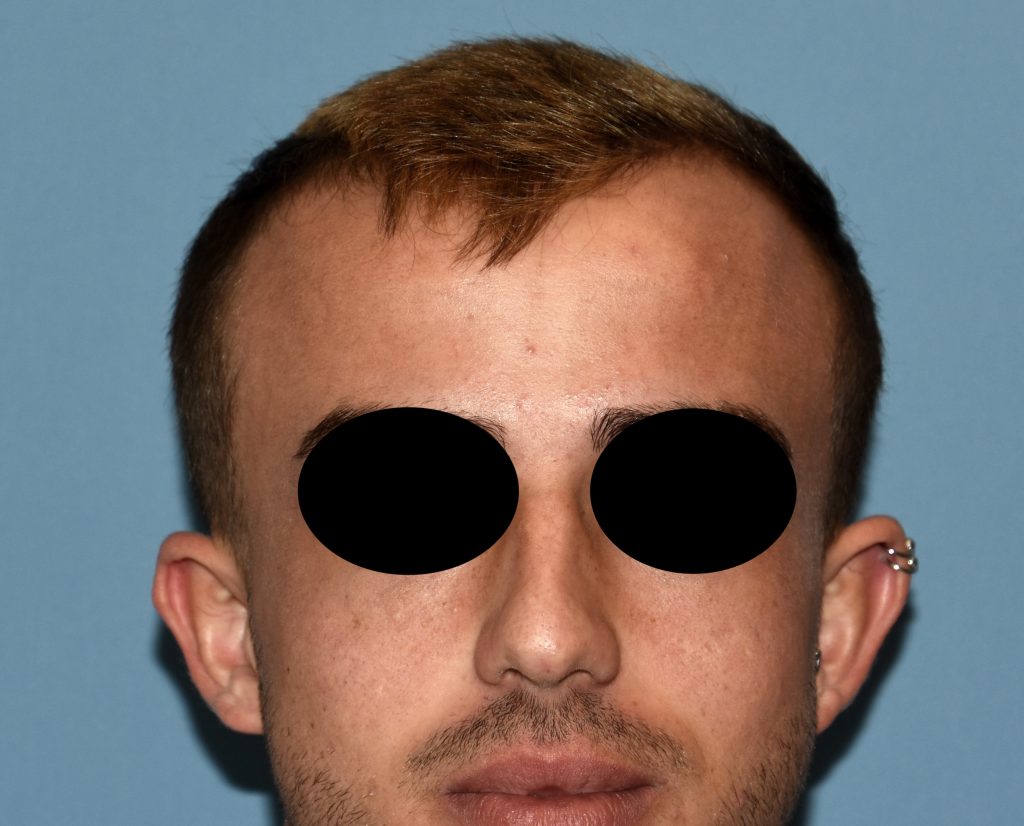 young male temporal reduction front 1 Dr Barry Eppley - Explore Plastic ...