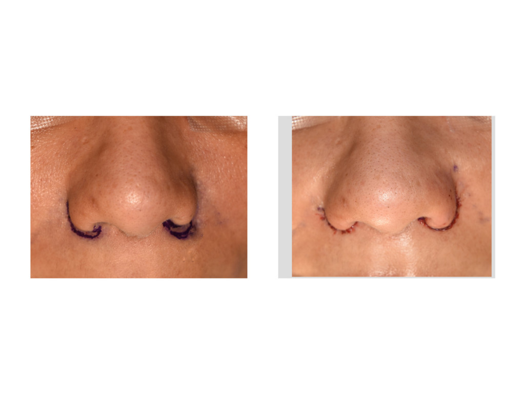 Alar Base Lowering in Rhinoplasty - Explore Plastic Surgery