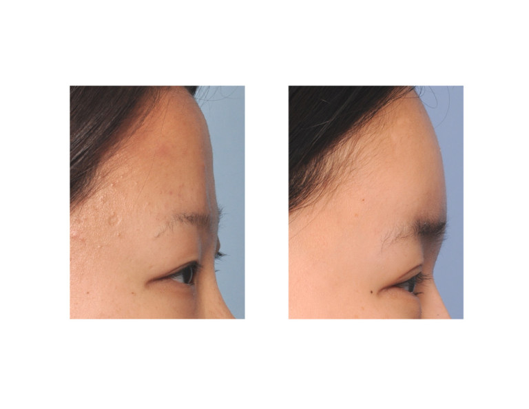 Concepts in Female Forehead Augmentation - Explore Plastic Surgery