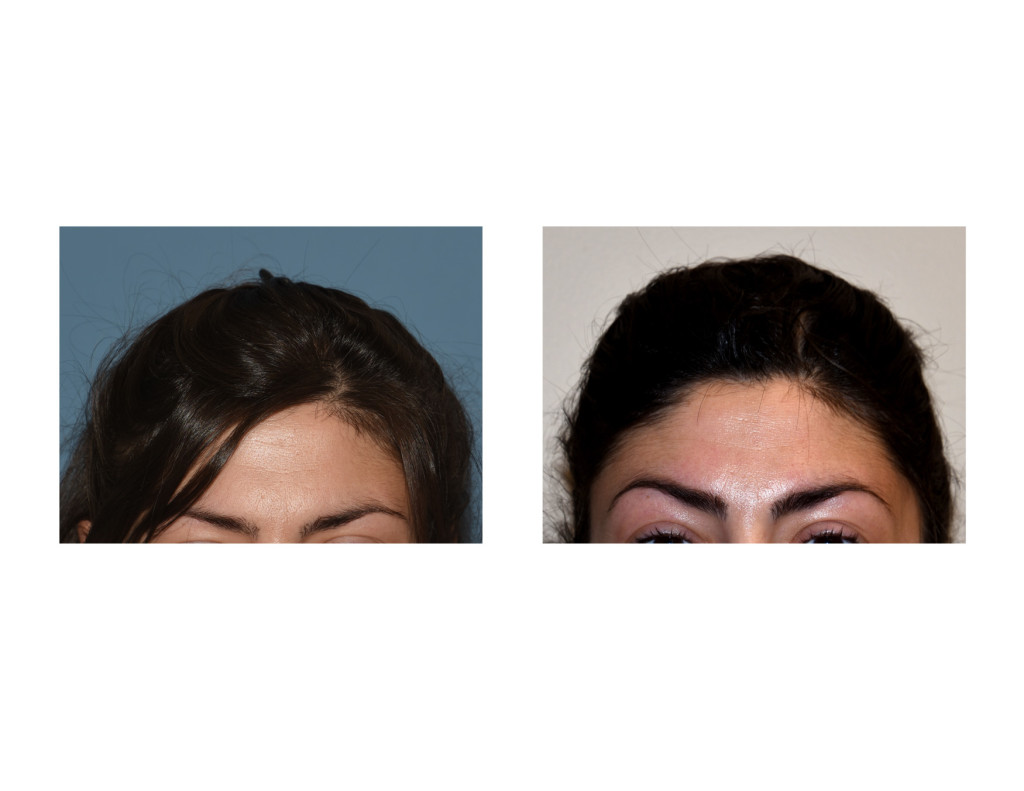 Plastic Surgery Case Study - The Bump It Custom Skull Implant - Explore ...