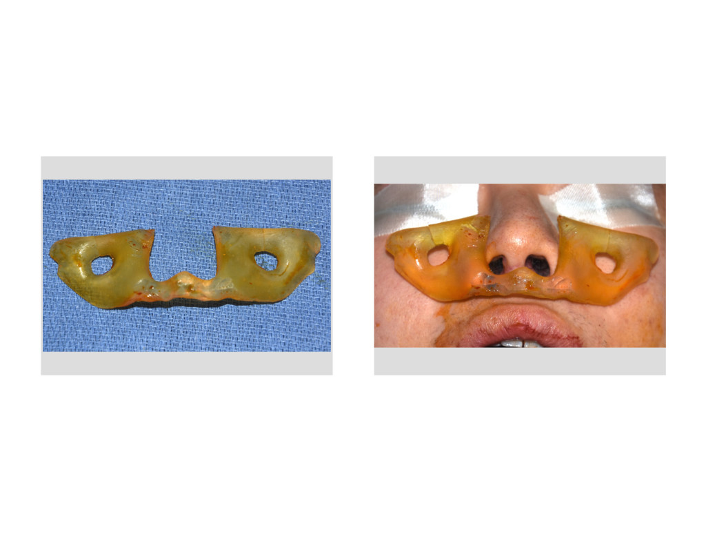 The Custom Midface Implant for Increased Midface Projection - Explore ...
