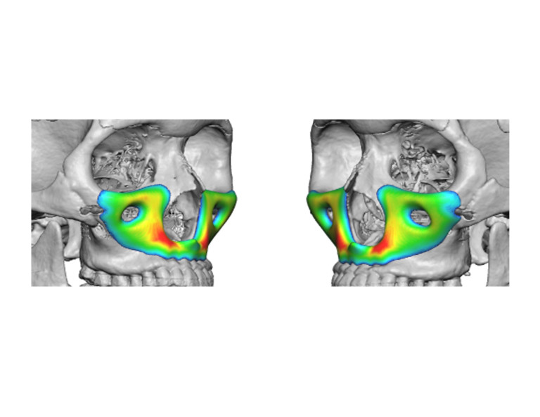 The Custom Midface Implant for Increased Midface Projection - Explore ...