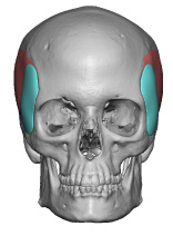 Extended Anterior Temporal Implant Design front view Dr Barry Eppley ...