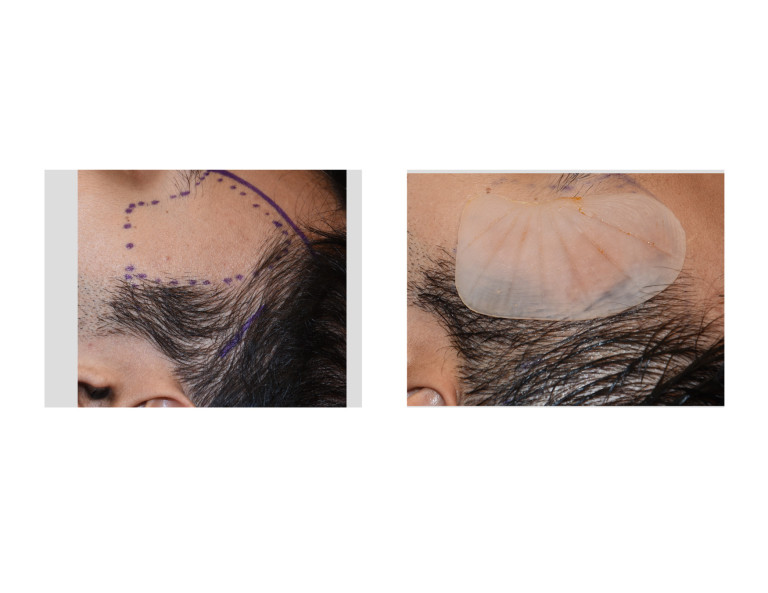 Extended Temporal Implants for More Superior Correction of Temporal ...