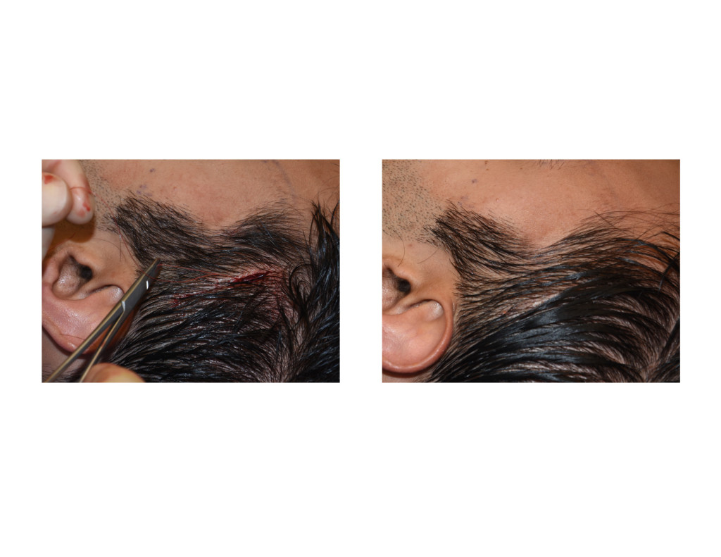 Extended Temporal Implants for More Superior Correction of Temporal ...