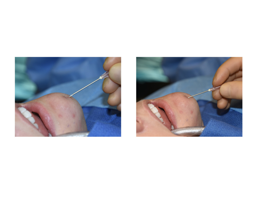 Fat Injection Chinj Dimple technique skin release Dr Barry Eppley ...