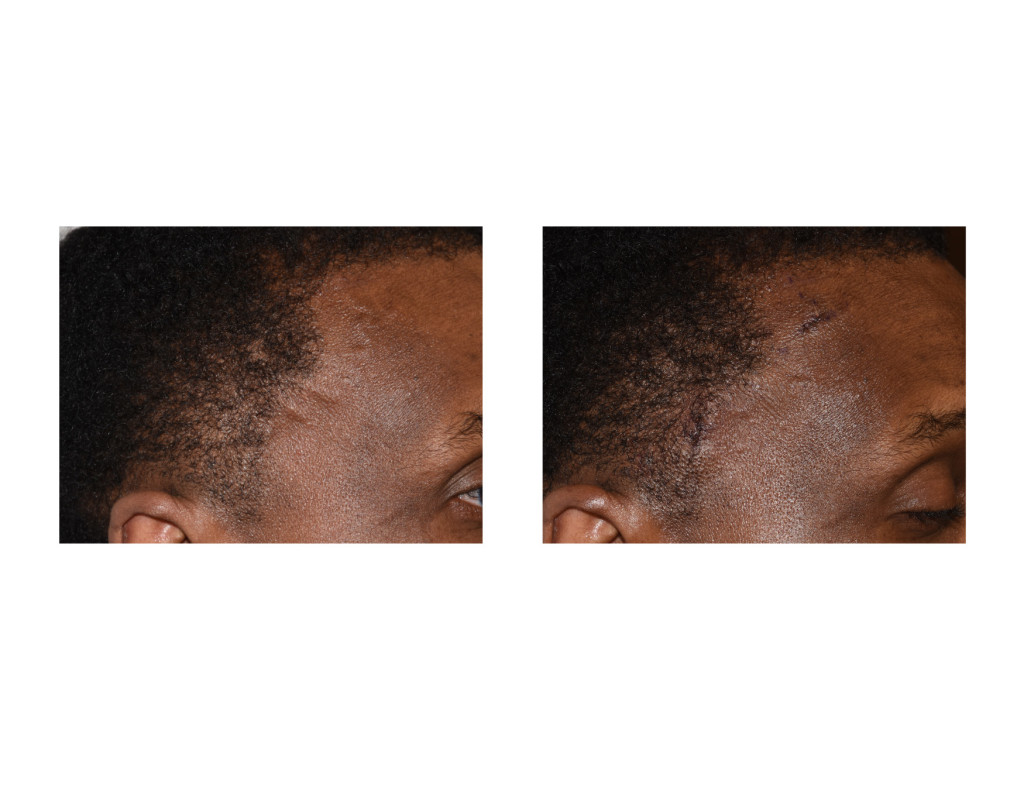 Plastic Surgery Case Study - Temporal Artery Ligation for Prominent ...