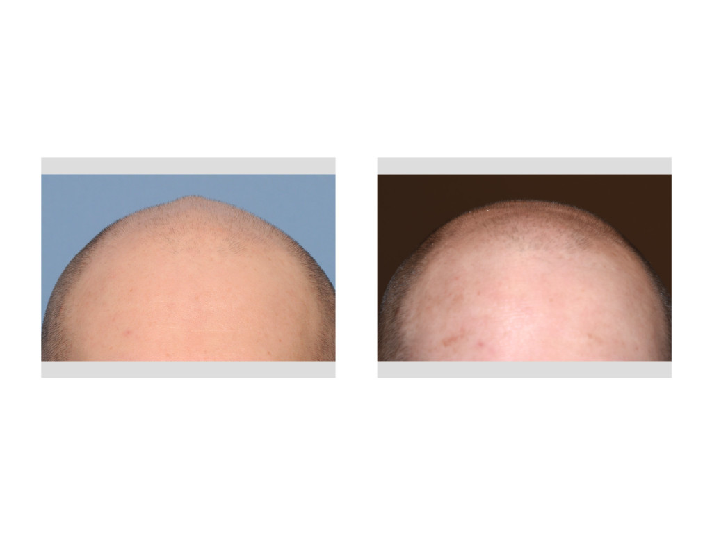 Plastic Surgery Case Study - Sagittal Ridge Skull Reduction - Explore ...