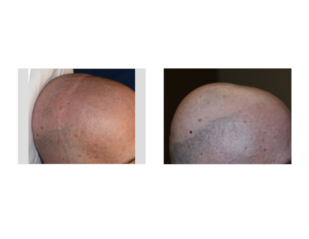 Technical Strategies - Fat Grafting A Custom Skull Implant Visible Edge ...